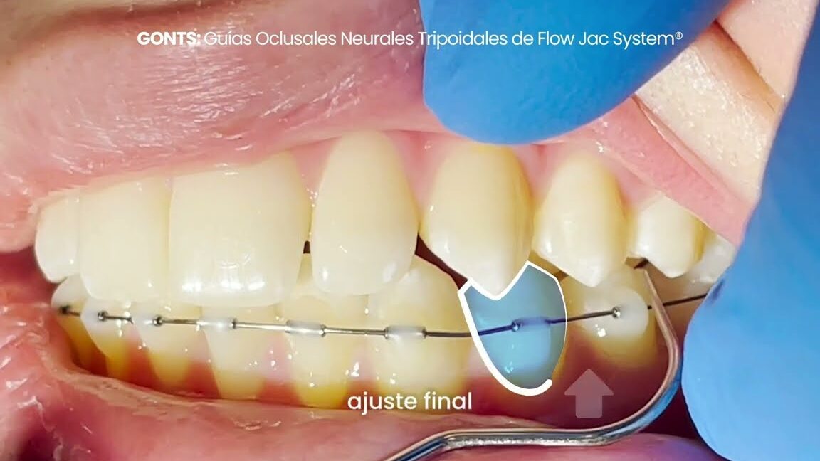 Flow Jac system ventajas y desventajas: ¿la mejor ortodoncia para ti?