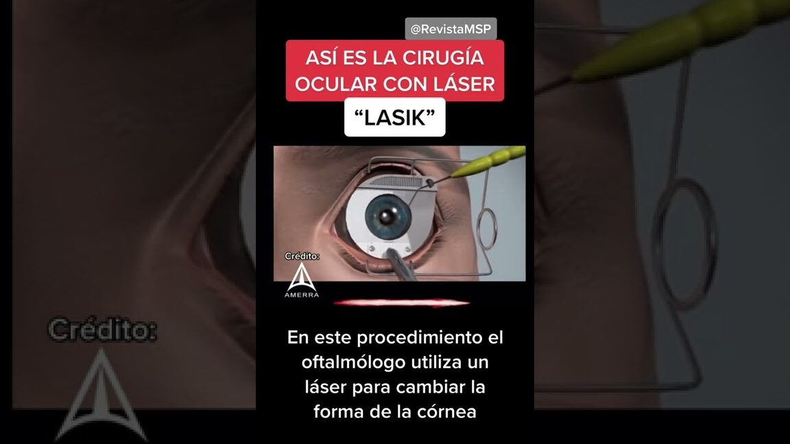 Operación láser ojos ventajas y desventajas: descubre si es para ti